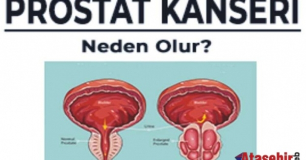 Prostat kanseri nedir?Ataşehir | Ataşehir Haber | Ataşehir Haberleri | Son Dakika Ataşehir Haberler